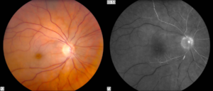 CRAO - Retina Consultants, PLLC